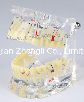 Dental Adult Transparent Pathology Model Deletion of dental caries dental caries missing model supplier
