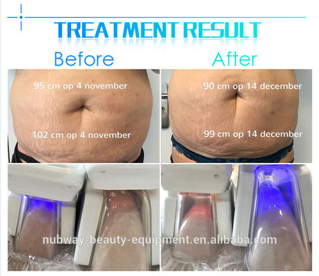 4 handles Cryo Therapy Cool Sculpture Zeltiq cryolipolysis machine 2018