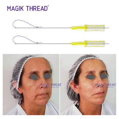 Tornado Screw Pdo Thread Lift Korea for Skin Tightening and Face Lifting