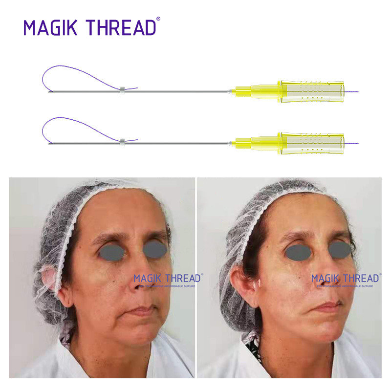 Tornado Screw Pdo Thread Lift Korea for Skin Tightening and Face Lifting