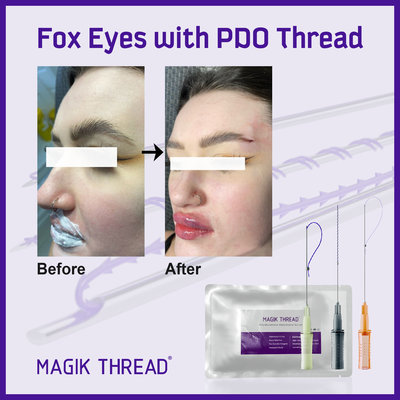 agik Thread 4D Cog Pdo Threads Barb Blunt Needle Cannula Thread Lift for Eye Face Nose