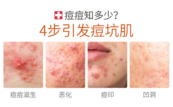 Herbal skin repairing and acne print eliminating essence for both man and woman