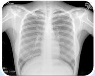Laser X-Ray Medical Dry Film Compatible With Fuji Thermal Printers