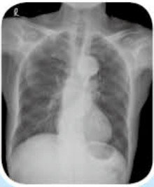 Laser X-Ray Medical Dry Film Compatible With Fuji Thermal Printers