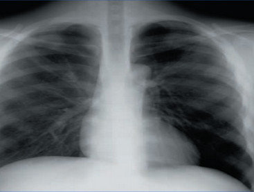 Blue Sensitive 20x40cm Medical Laser X Ray Film For Viscera Examination