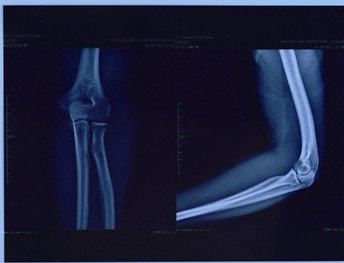 Bluish Polyester Base Laser X Ray Film Used In Thermal Camera
