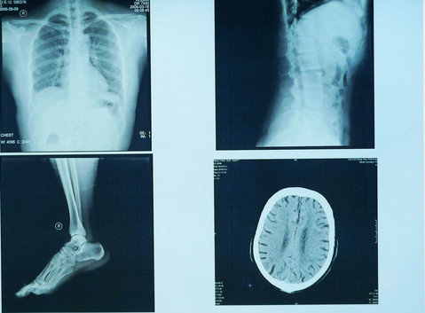 Bluish Polyester Base Laser X Ray Film Used In Thermal Camera