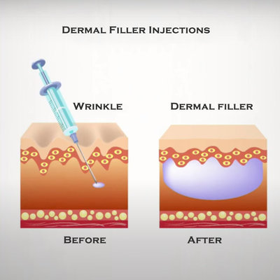 Hyaluronic Acid Dermal Filler Korea for Lips Ultra TOP-Q Deep 2cc