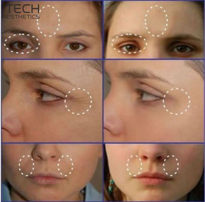 50 VA Power Skin Tightening Oxygen Facial Machine 50/60Hz Frequency