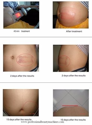 Vertical Cryolipolysis Slimming Machine 4 Handles For Body Shaping / Fat Removal