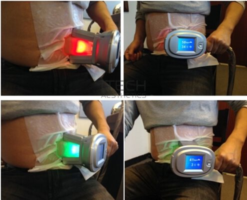 Body Slimming And Shaping Cryolipolysis 2 Handles Fat Freezing Machine Weight Losing Slimming Machine