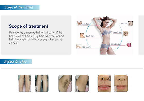 diode laser hair removal machine 808nm painless hair removal laser diode
