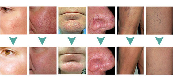 Varicose Spider Veins Removal Of Red Blood , Blood Vessels Removal
