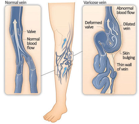Varicose Spider Veins Removal Of Red Blood , Blood Vessels Removal