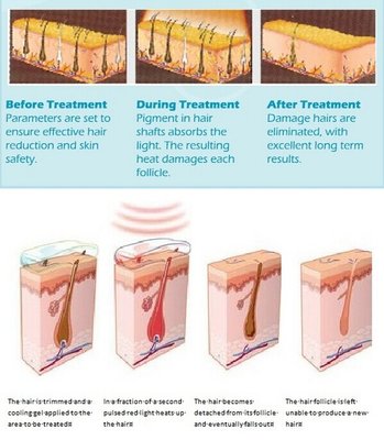 Skin Rejuvenation Portable IPL Hair Removal Machine CE Approved