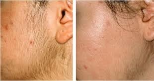 Skin Rejuvenation Portable IPL Hair Removal Machine CE Approved