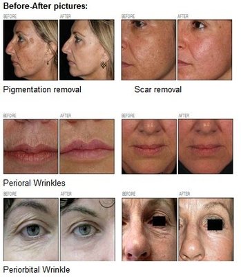 40W 10600nm Glass pipe Skin resurfacing Fractional CO2 Laser machine clinic