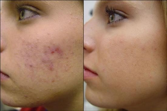medical laser skin tightening wrinkles removal RF Pipe Fractional CO2 Laser