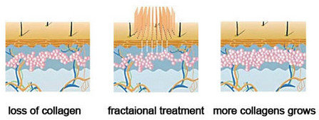 rf pipe fractional CO2 laser 10600nm fractional co2 laser