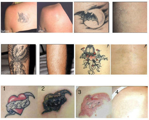 Q Switched ND YAG Laser Tattoo Removal Machine for Eliminate Coffee Spot