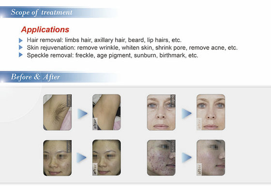 shr ipl hair removal machine ipl laser hair removal machine for sale