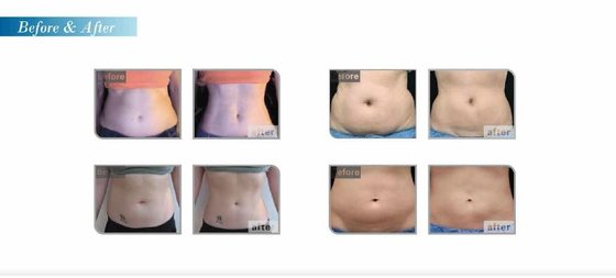 Nubway technology!!! 2015 hifushape slimming machine same as ultrashape hifu