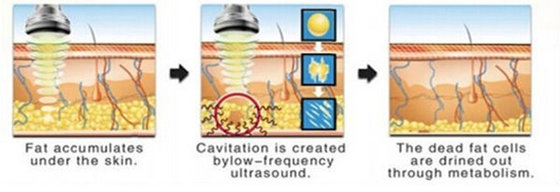 40KHz NEW 40Khz Ultrasonic Liposuction Cavitation Slimming Machine For Body Contouring