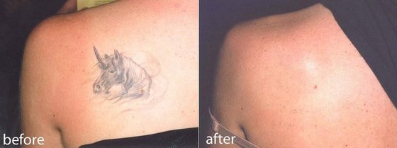 Excellent result Q Switch nd yag laser tattoo removal machine
