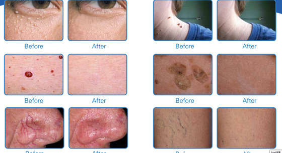 Painfree vein treatment machine with Truly 30MHZ