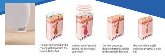 CE approved Medical equipment distributors agents required 808 diode laser hair removal machine