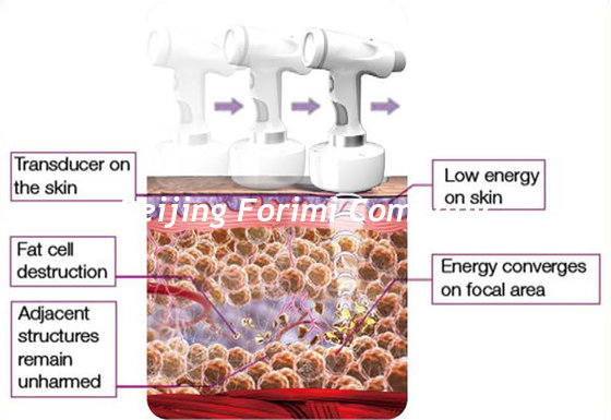 10Mhz liposonix hifu for fat reduction high intensity focused ultrasound 300W hifu for body slimming HIFUmachine