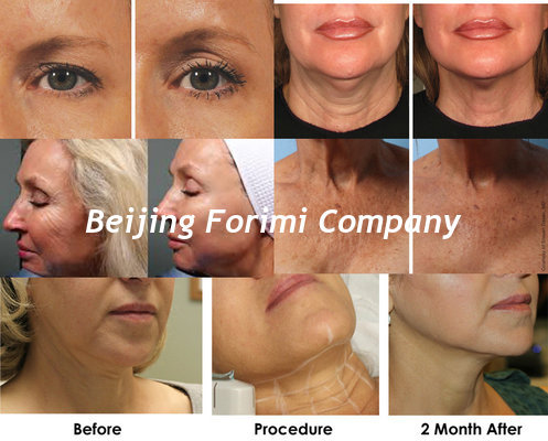 high frequency HIFU face firming HIFU-f face lift machine face smooth wrinkle removal