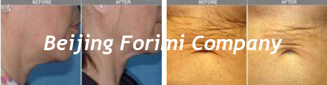 korea best rf stomach laser skin tightening stomach wave ferquency device  monopolar radio frequency machin