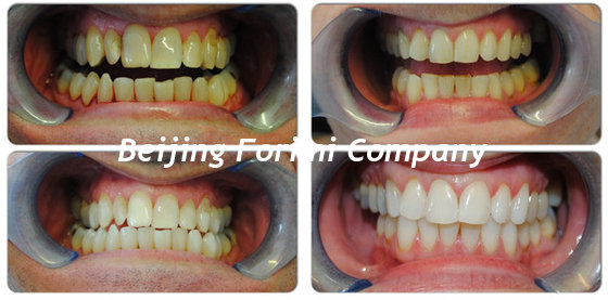 Professional LED light teeth whitening machine with mouth gag for sale