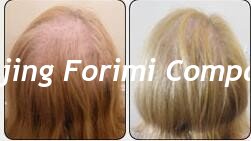 Professional 3 type LED combined 650nm 808nm diode laser hair regrowth machine