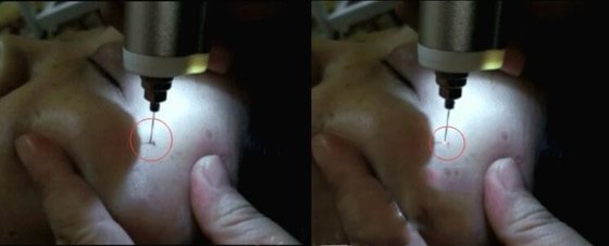 Non-invasive Plexr Plasma Pen Soft Surgery Device For Beauty SPA SALON Italian Technology supplier