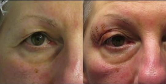 Portable PLEXR Non-Surgical Blepharoplasty SPA Salon's best choice supplier