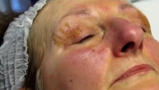 Portable PLEXR Non-Surgical Blepharoplasty SPA Salon's best choice supplier