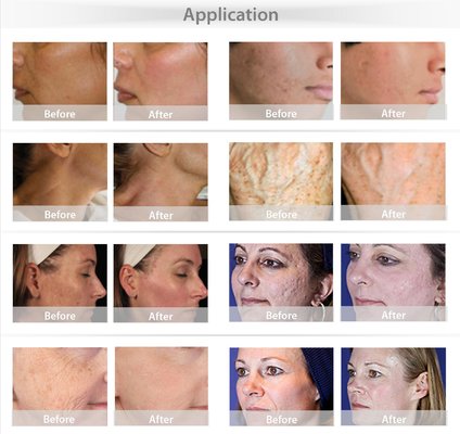 Medical Spider Vein Removal Machine For Skin Rejuvenation 50HZ 100 / 110V supplier