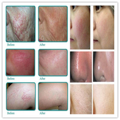 High Frequency Spider Vein Removal Machine / Leg Blood Vessel Treatment supplier