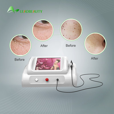30Mhz high frequency Spider Vein removal price / using for vascular removal with 8.4 inch screen /150W skin tag removal