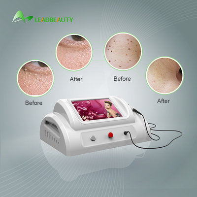 30Mhz high frequency Spider Vein removal price / using for vascular removal with 8.4 inch screen /150W skin tag removal