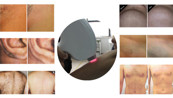 2017 medical CE approved vertical spa use women hair removal machine