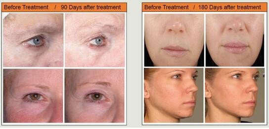 New technology hifu high intensity focused ultrasonic for face uplift korea hifu