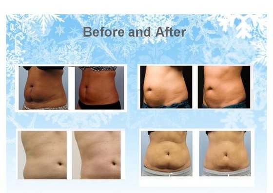 2016 Newest freeze fat and body slimming machine with two handles with CE approved
