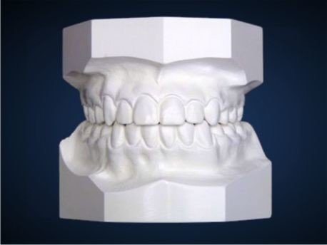 Plaster Dental Model stuck in Shanghai customs - fedex parcel customs clearance agent