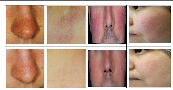 SHF-1 with CE certification for portable spider vein removal machine