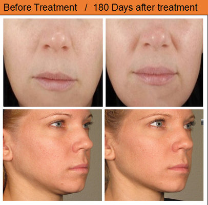 2 years warranty hifu  hifu hifu wrinkle removal
