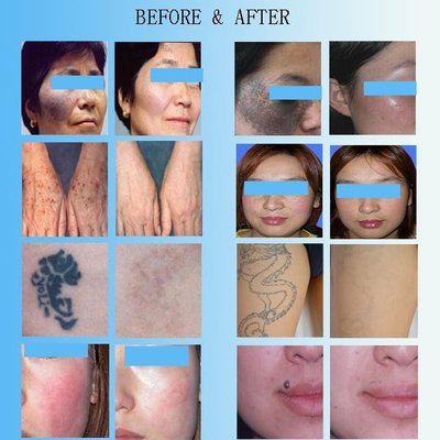 Beauty Best medical use Q-switched nd yag laser for tattoo removal/medical laser nd yag fi