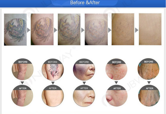 2017 high energy factory price q yag laser picosecond